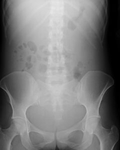 Cirrhose compliquée : Ascite